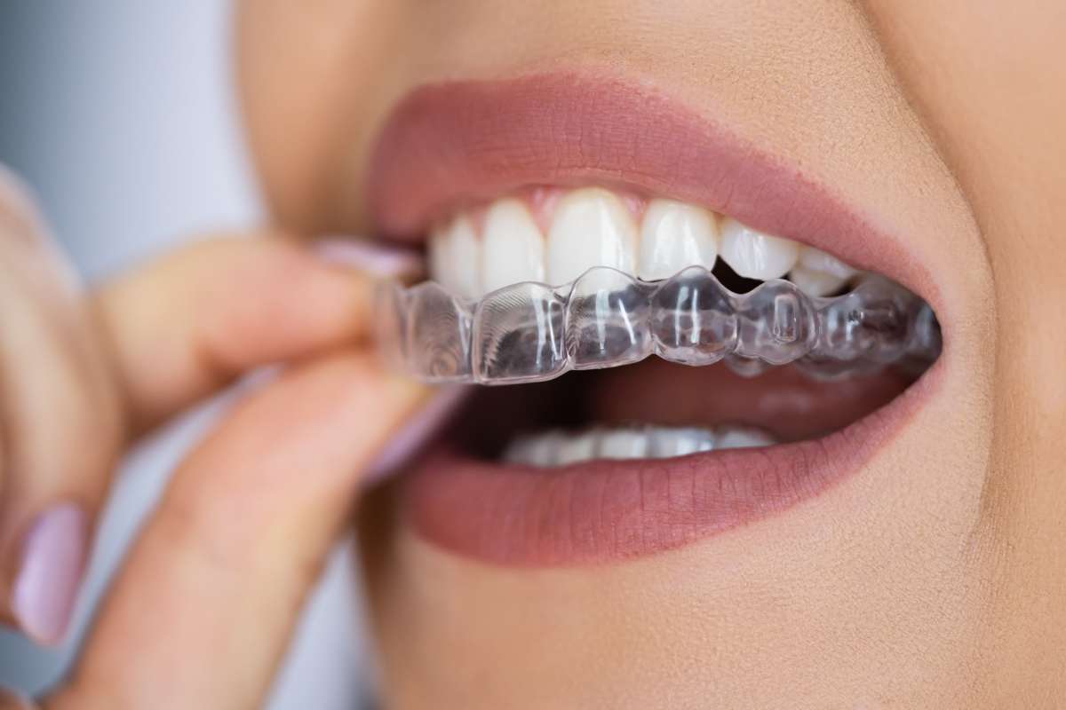 5 Reasons Why Invisible Tooth Aligners Are a Revolutionary Approach to ...